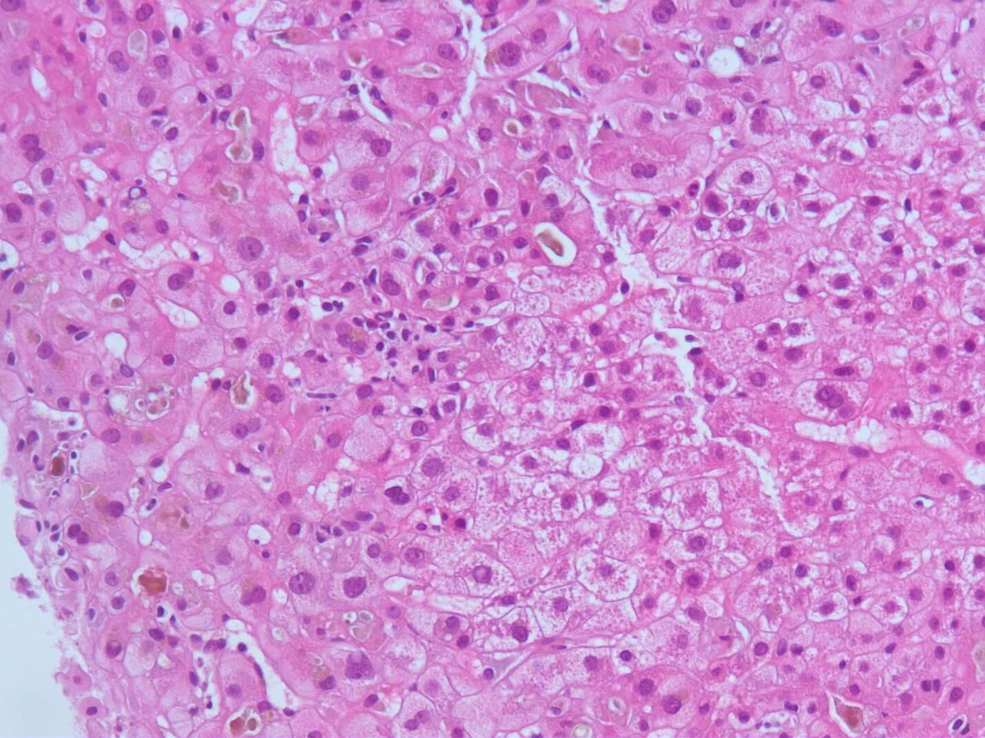 Does Ashwagandha cause liver toxicity, injury and damage? Here are the harmful effects and risks ...